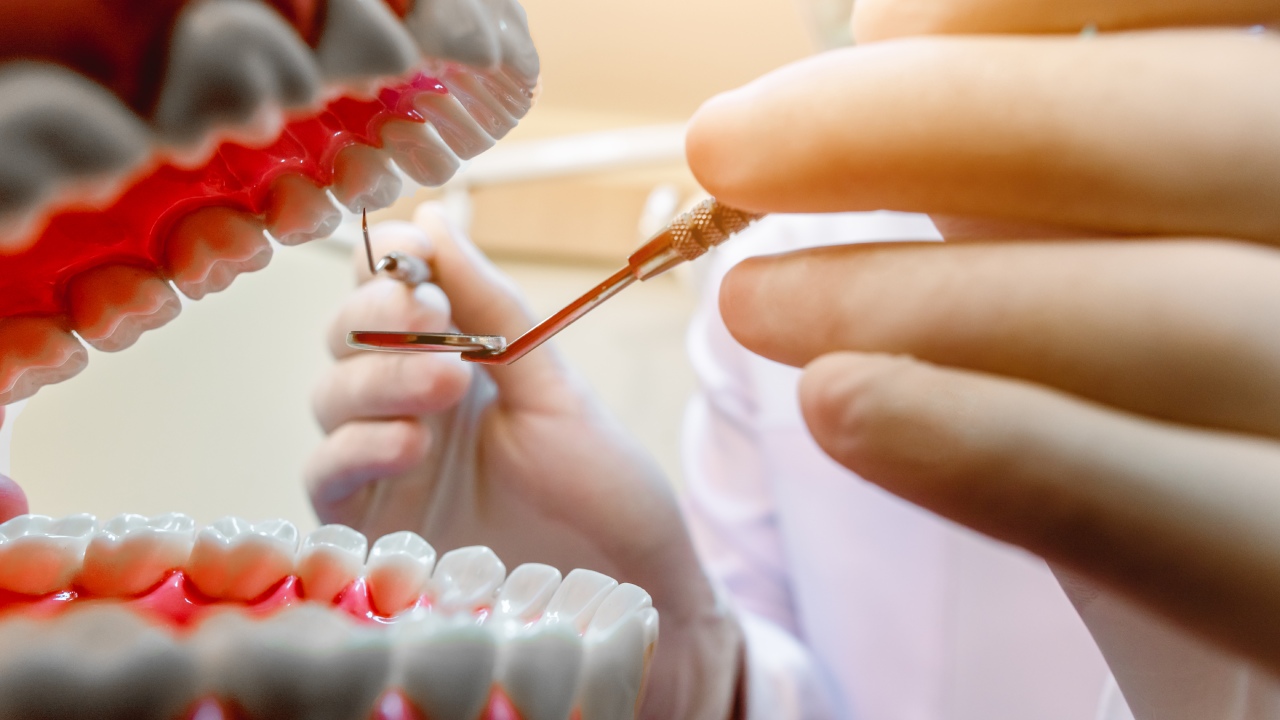 All-on-4 Dental Implants Surfside Beach, SC | Full Arch Restoration